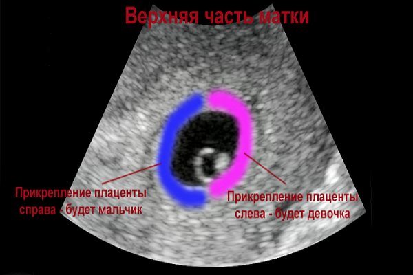 Пол ребенка НА 1 узи! Метод Рамзи +фото — 9 ответов | форум Babyblog